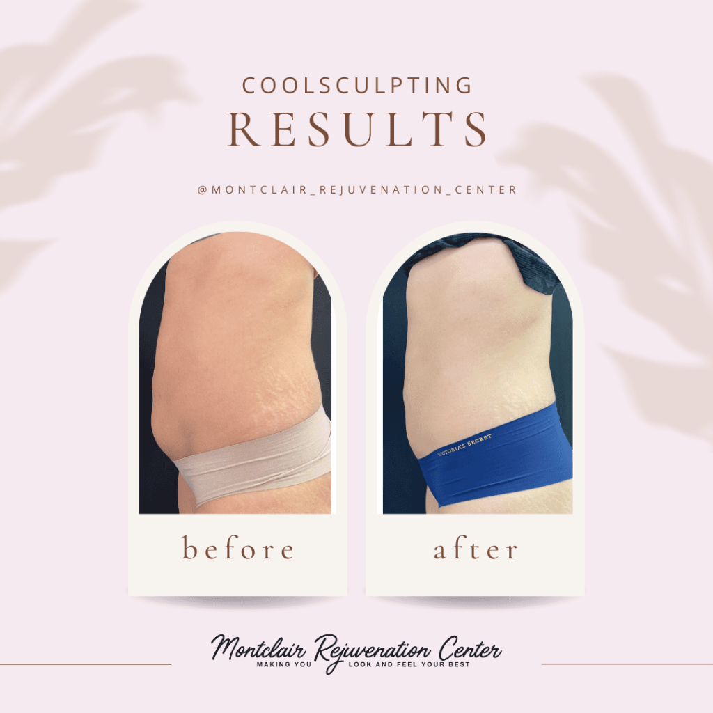 Before & Afters Verona & West Caldwell MedSpa | Montclair Rejuvenation ...